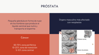 Cáncer de prostata_.pdf