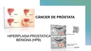 Cáncer de Próstata.pptx