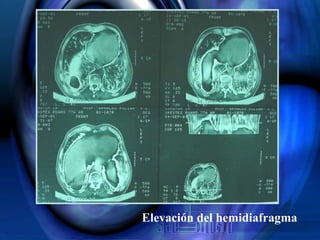 Cáncer de Pulmón.ppt