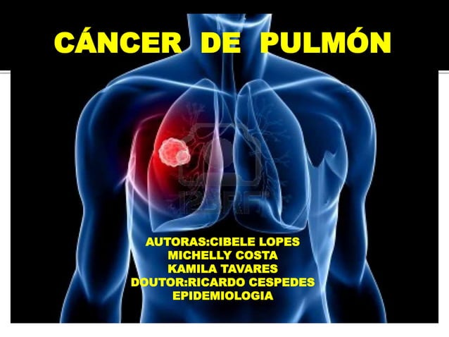 Cáncer De Pulmón Slide Ppt
