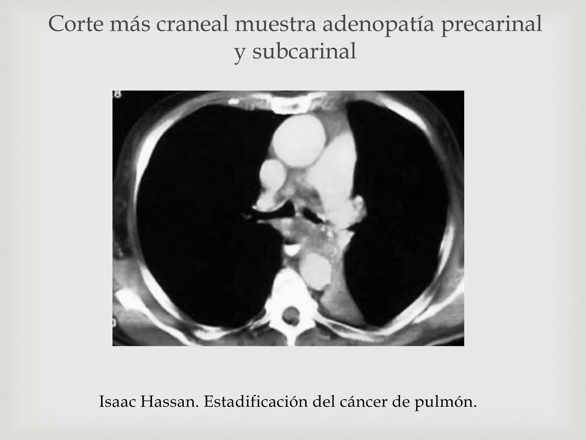 Imagenologia de Cáncer de pulmón primario y metastásico | PPTX