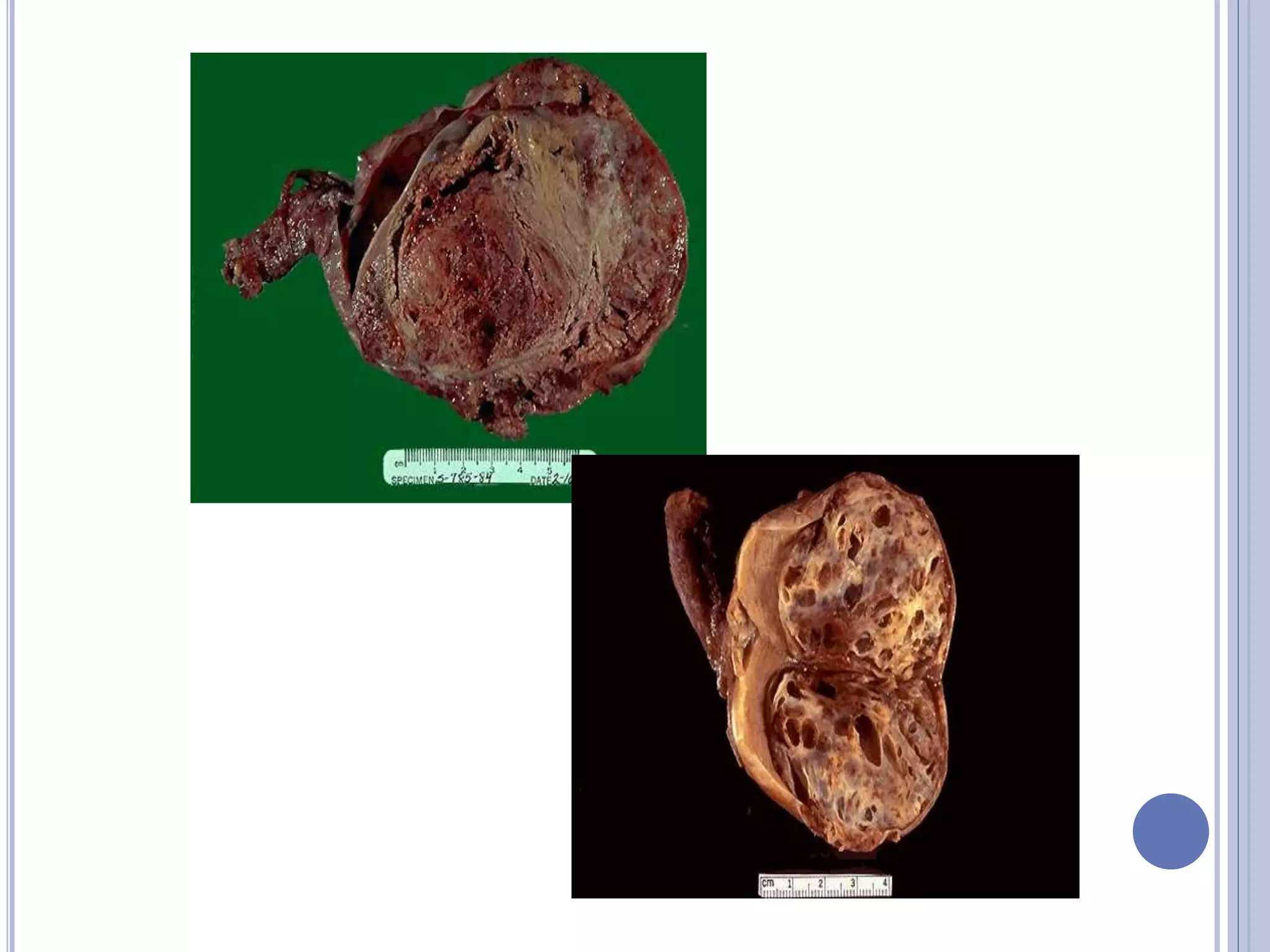 Cáncer de testículo | PPTX