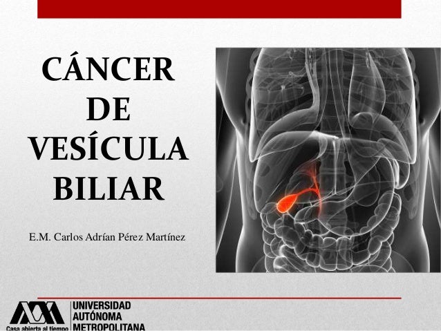 Cáncer de vesícula biliar