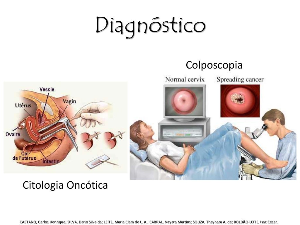 Câncer do colo do útero: Aspectos Gerais e Oncogênese