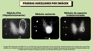 Exposición sobre el diagnóstico del cáncer tiroideo | PDF