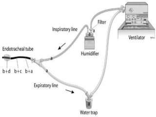 overview of mechanical ventilation and nursing care