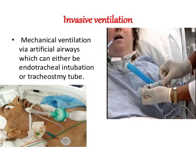 overview of mechanical ventilation and nursing care