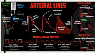 CNE Artline System in ICU. Care of arterial line in ICU and what need ...