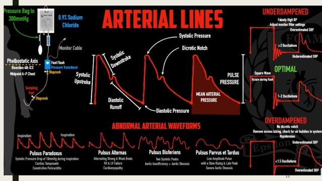 CNE Artline System in ICU. Care of arterial line in ICU and what need ...