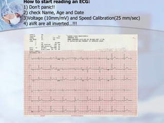BASIC ECG | PPT