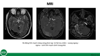 Dò động tĩnh mạch màng cứng.pptx