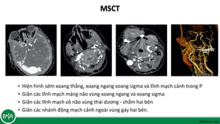 Dò động tĩnh mạch màng cứng.pptx