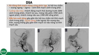 Dò động tĩnh mạch màng cứng.pptx