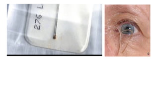 CNLDO-congenital Nasolacrimal Duct obstruction | PDF