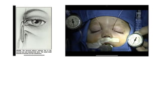 CNLDO-congenital Nasolacrimal Duct obstruction | PDF