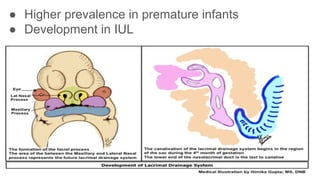 CNLDO-congenital Nasolacrimal Duct obstruction | PDF
