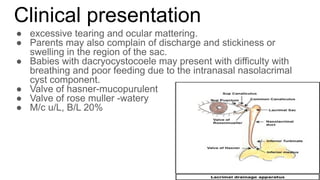 CNLDO-congenital Nasolacrimal Duct obstruction | PDF