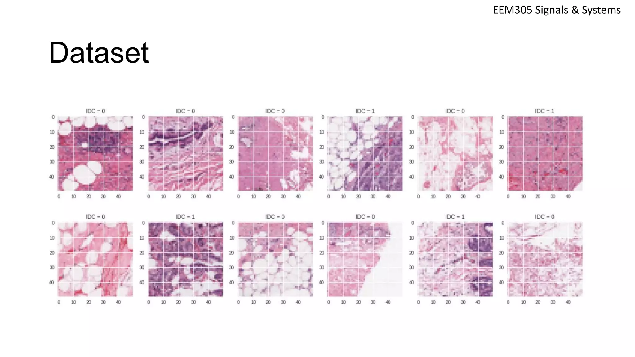 Breast Cancer Detection With Convolutional Neural Networks Cnn Pptx