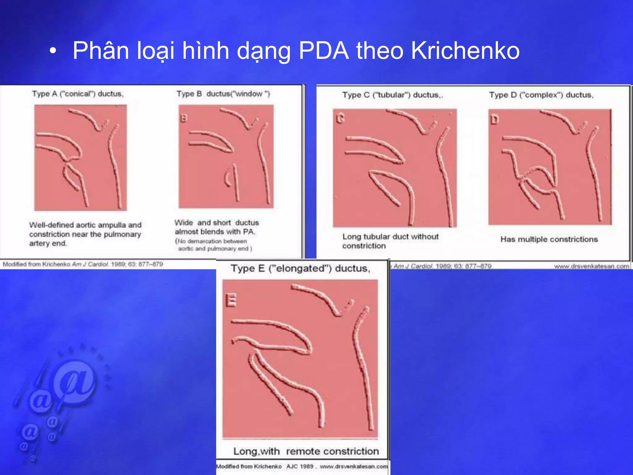 CÒN ỒNG ĐỘNG MẠCH PDA | PDF