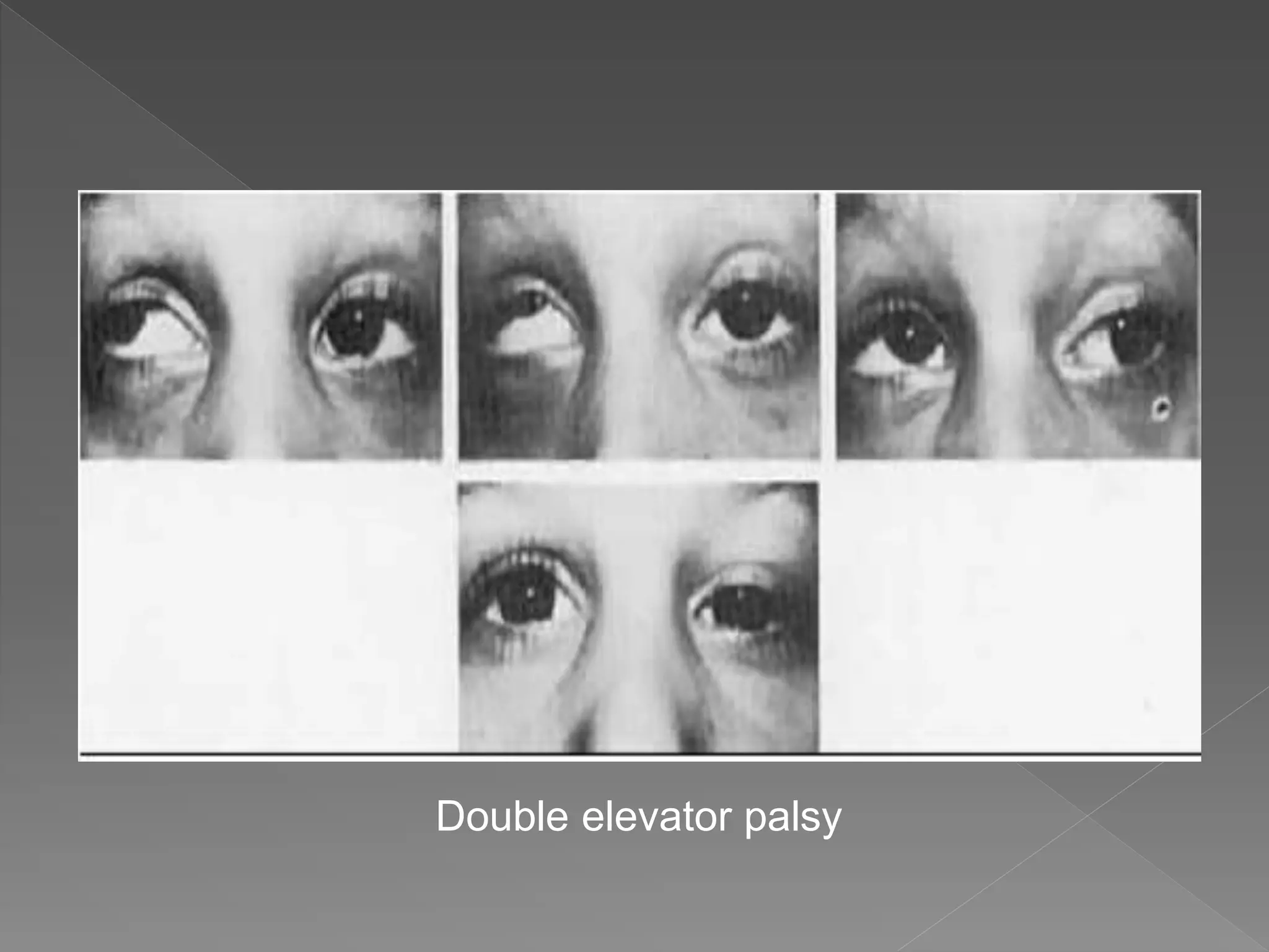 3rd, 4th, & 6th cranial nerve palsy | PPTX