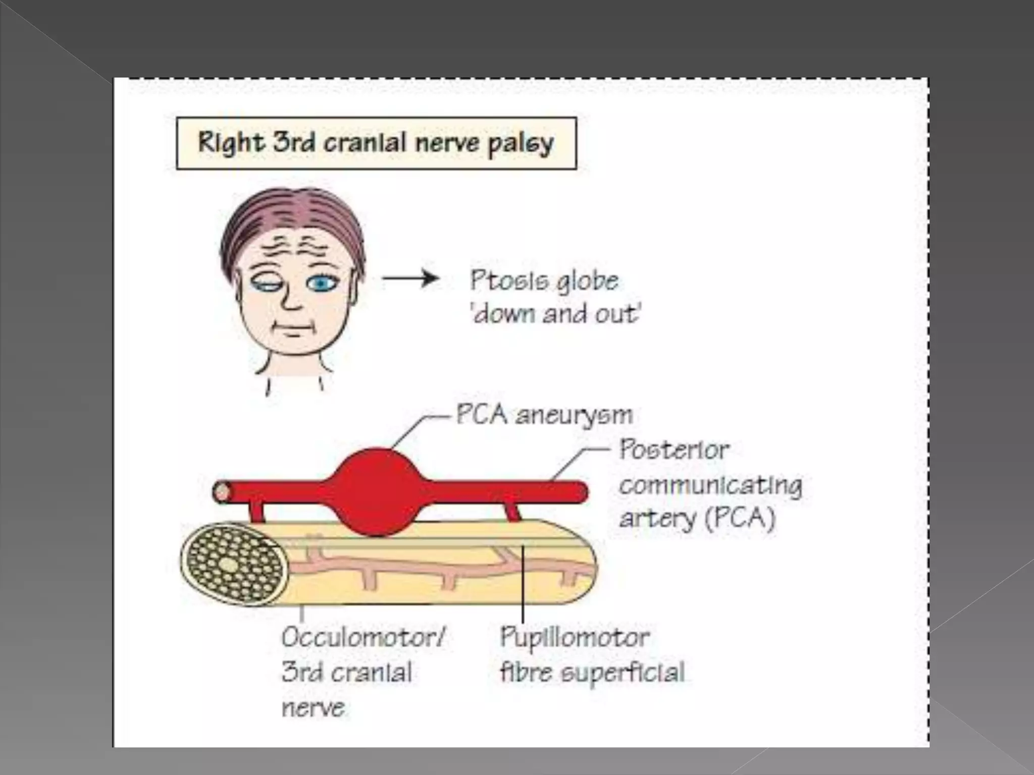 3rd, 4th, & 6th cranial nerve palsy | PPTX | Eye and Vision Conditions | Diseases and Conditions