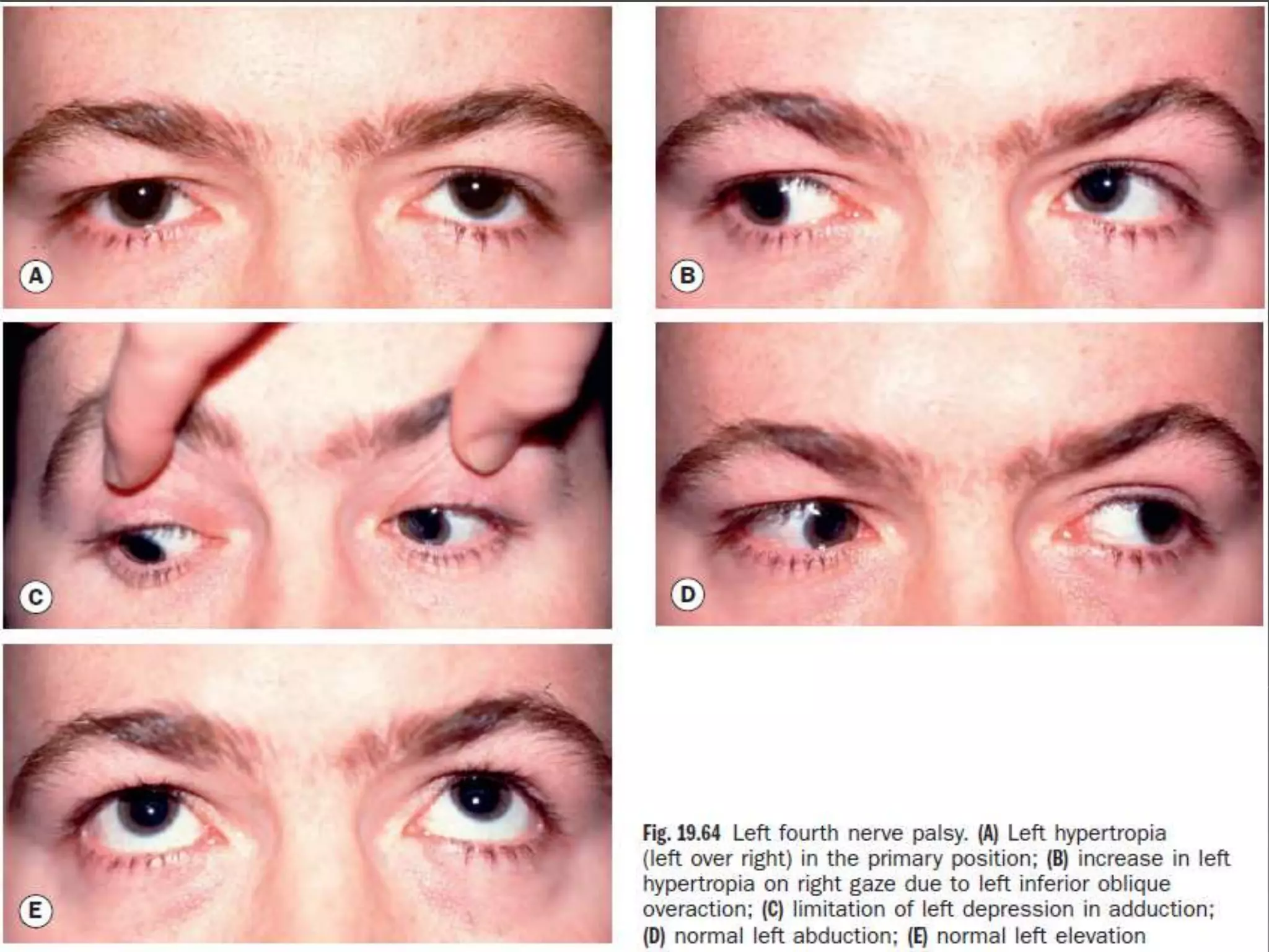 3rd, 4th, & 6th cranial nerve palsy | PPTX | Eye and Vision Conditions ...