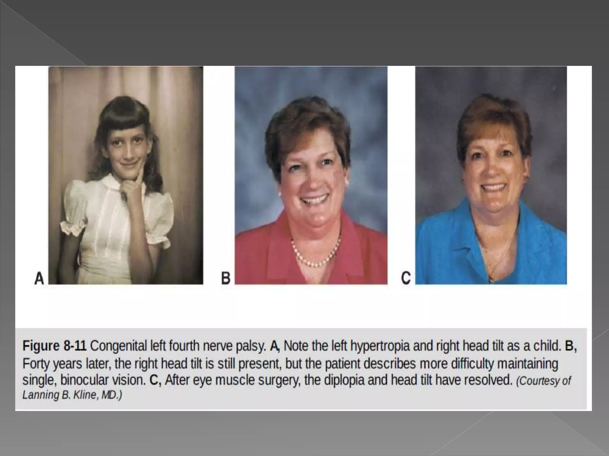 3rd, 4th, & 6th cranial nerve palsy | PPTX
