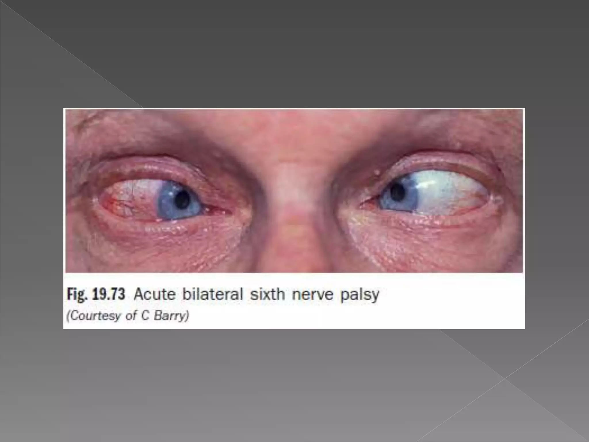 3rd, 4th, & 6th cranial nerve palsy | PPTX | Eye and Vision Conditions ...