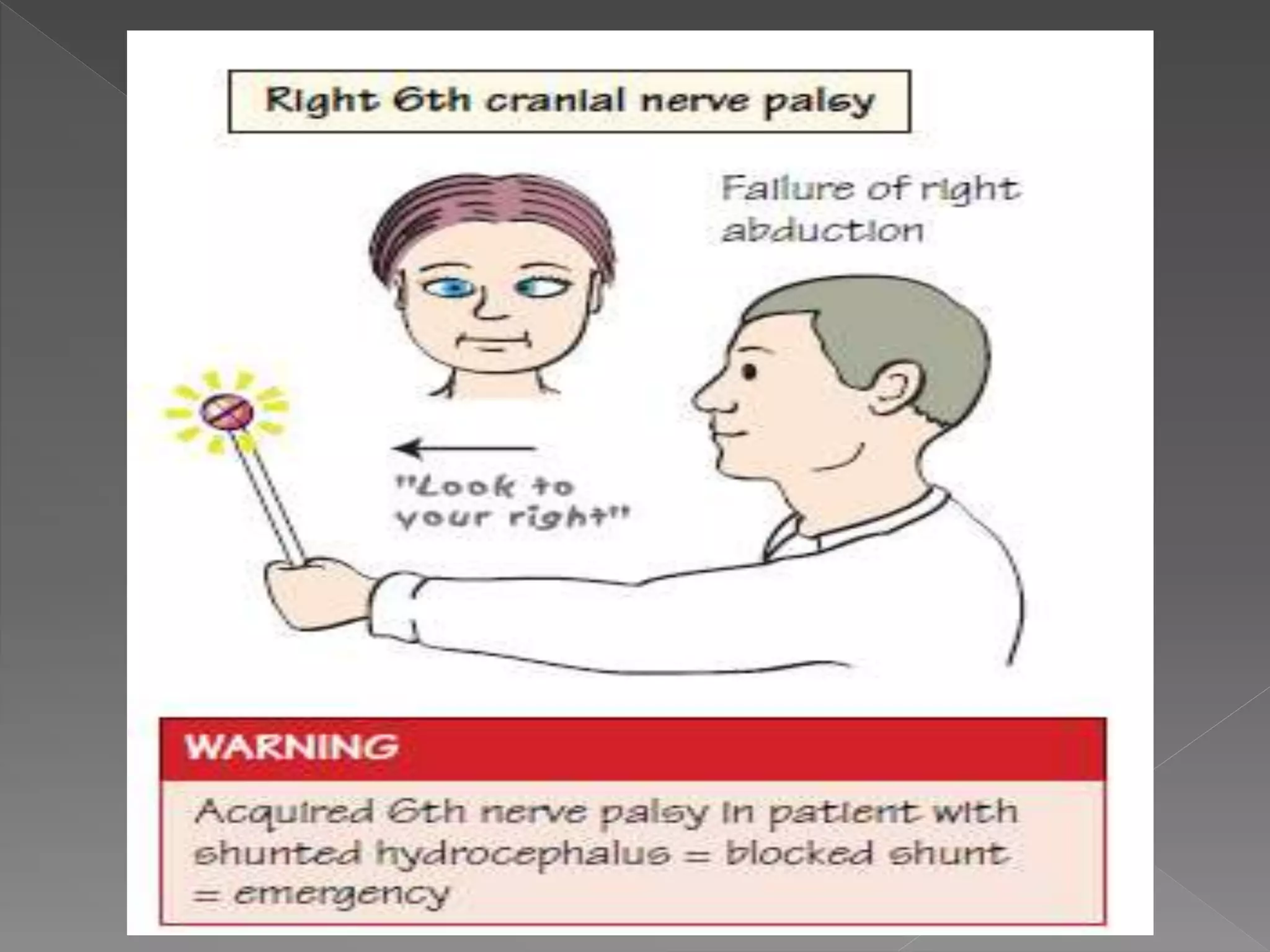 3rd, 4th, & 6th cranial nerve palsy | PPTX