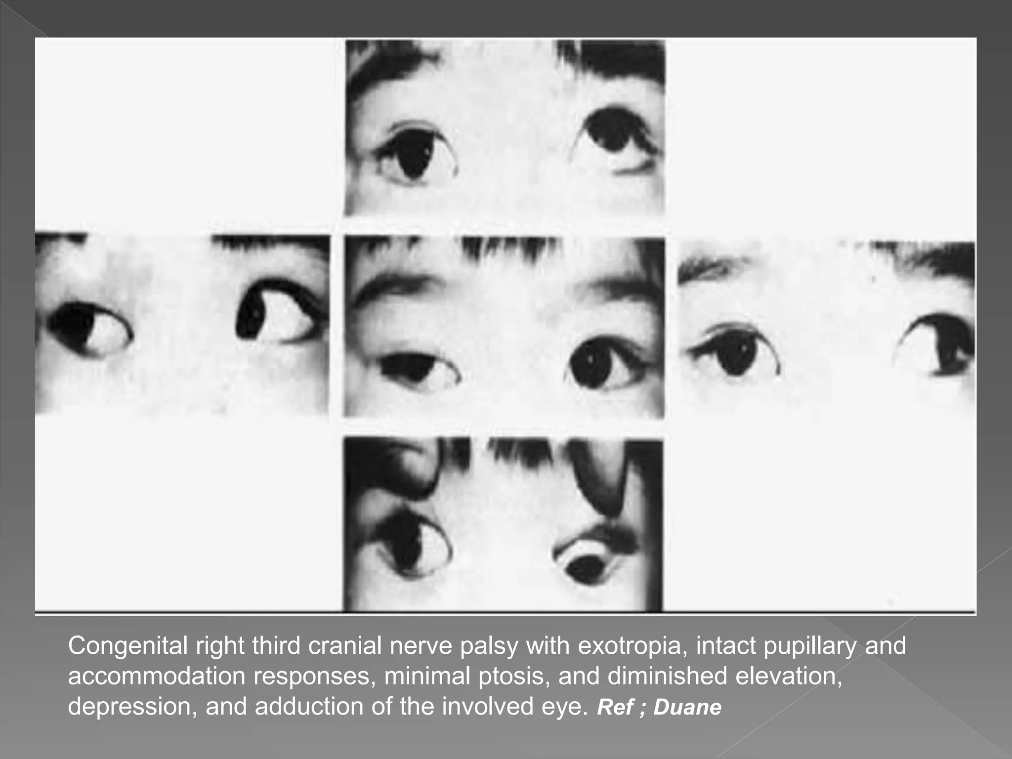 3rd, 4th, & 6th cranial nerve palsy | PPTX