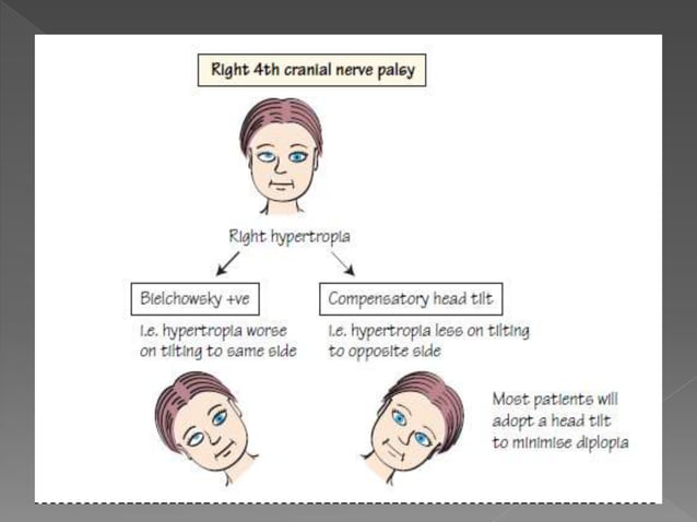 3rd, 4th, & 6th cranial nerve palsy