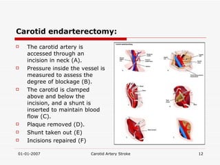 Carotid Artery Stroke | PPT