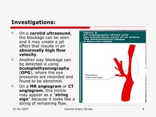 Carotid Artery Stroke | PPT