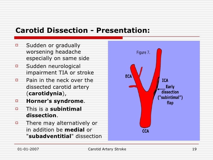 Carotid Artery Stroke