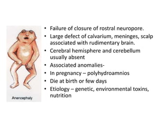 Neural tube defects and Craniosynostosis | PPT