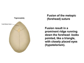 Protruding Metopic Suture