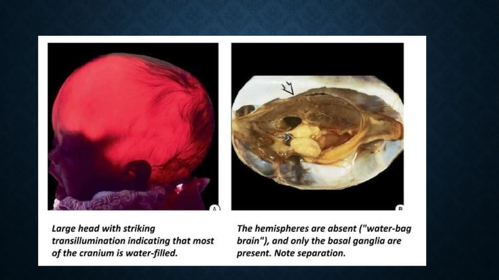 CNS CONGENITAL ANOMALIES-2.Imaging approach | PPTX