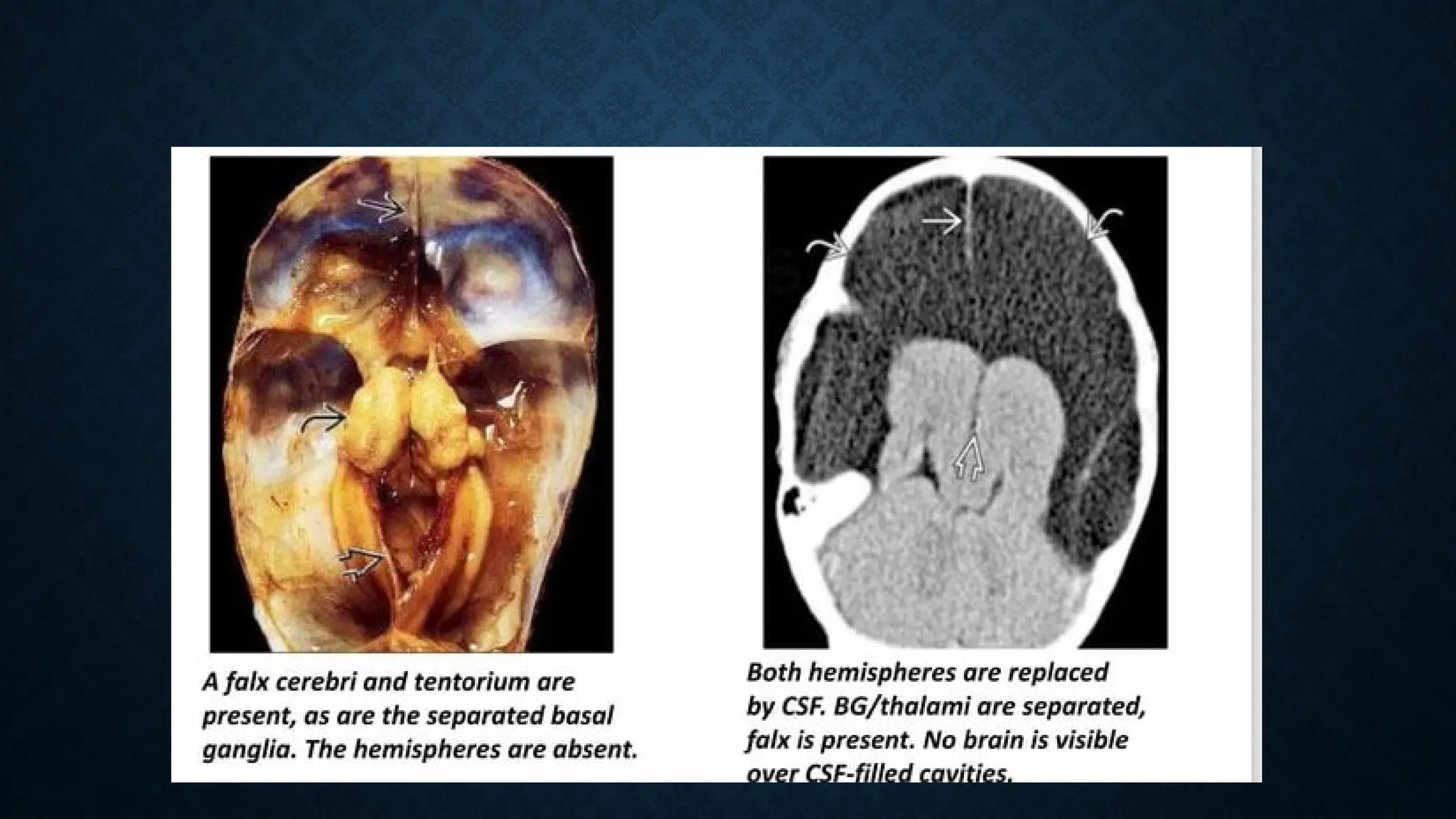 CNS CONGENITAL ANOMALIES-2.Imaging approach | PPTX