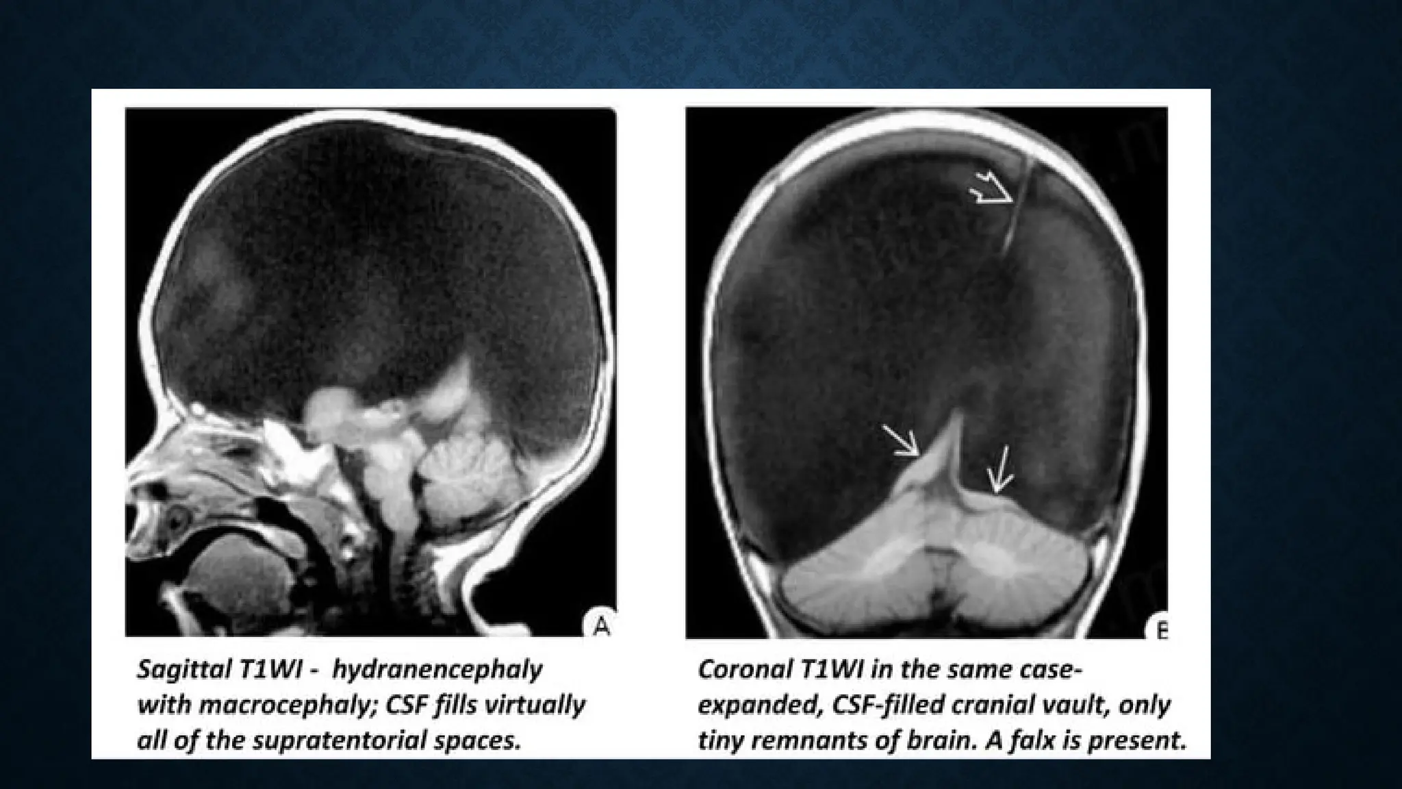 CNS CONGENITAL ANOMALIES-2.Imaging approach | PPTX