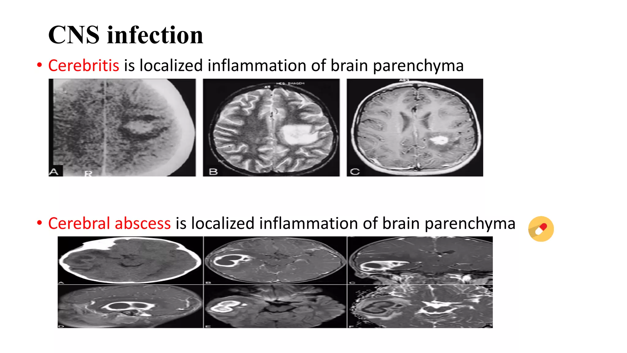 Cns infection | PDF