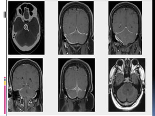 CT HEAD FOR DIAGNOSIS OF COMMON CNS INFECTIONS | PPTX