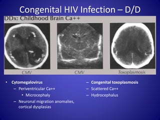 Cmv Periventricular Calcification