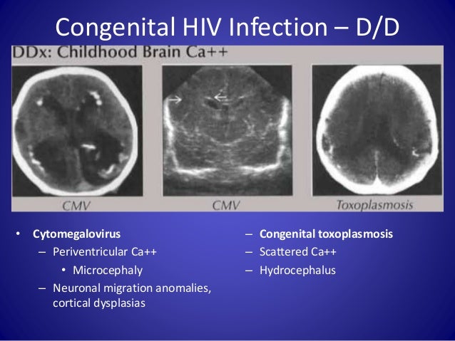 CNS infections