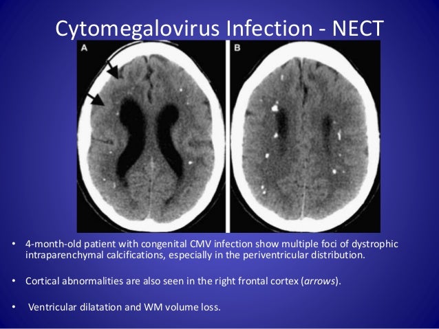 CNS infections