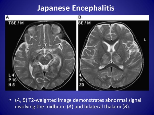 Encephalitis Lethargica