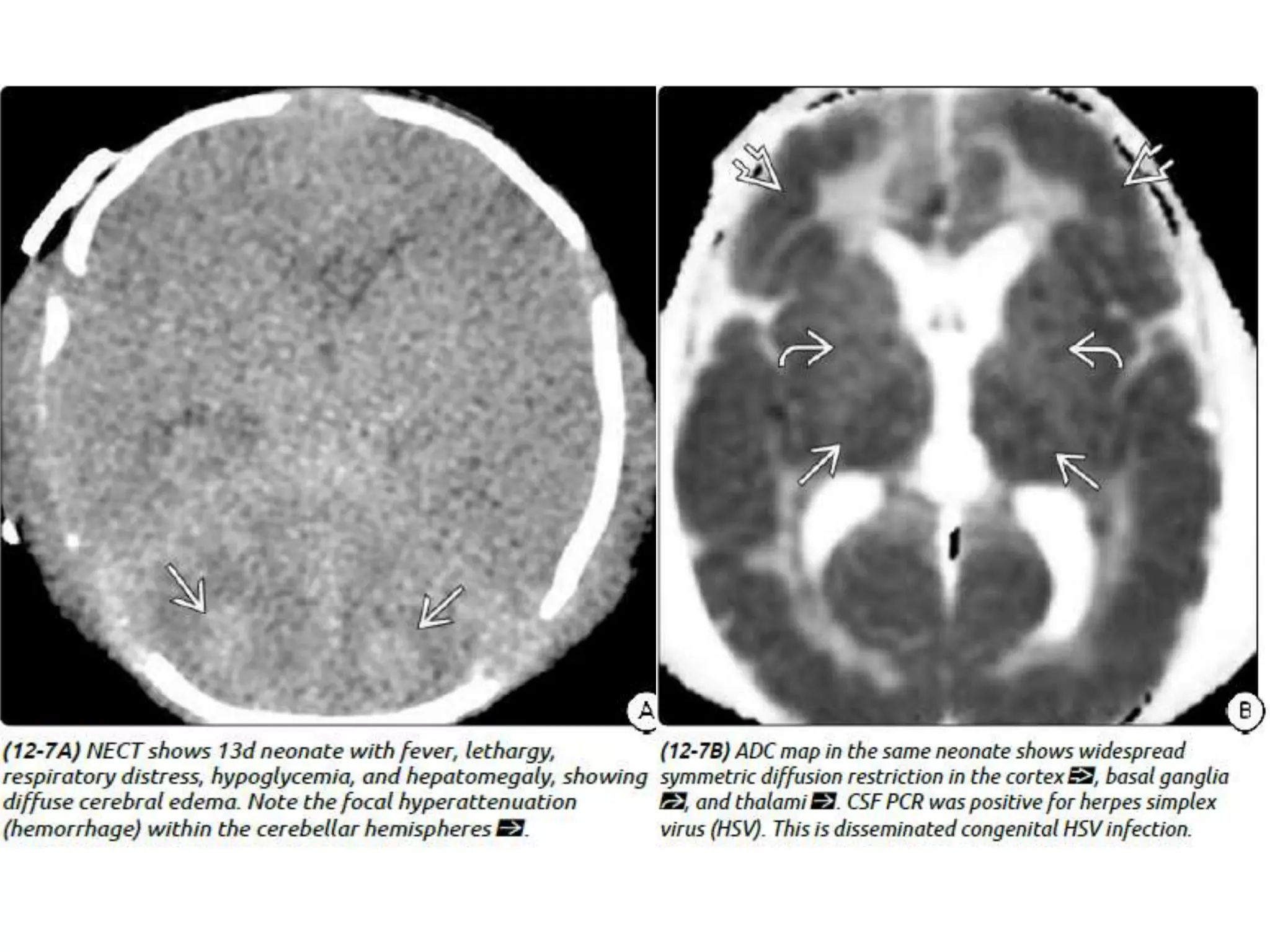 Imaging in CNS Infections | PPTX
