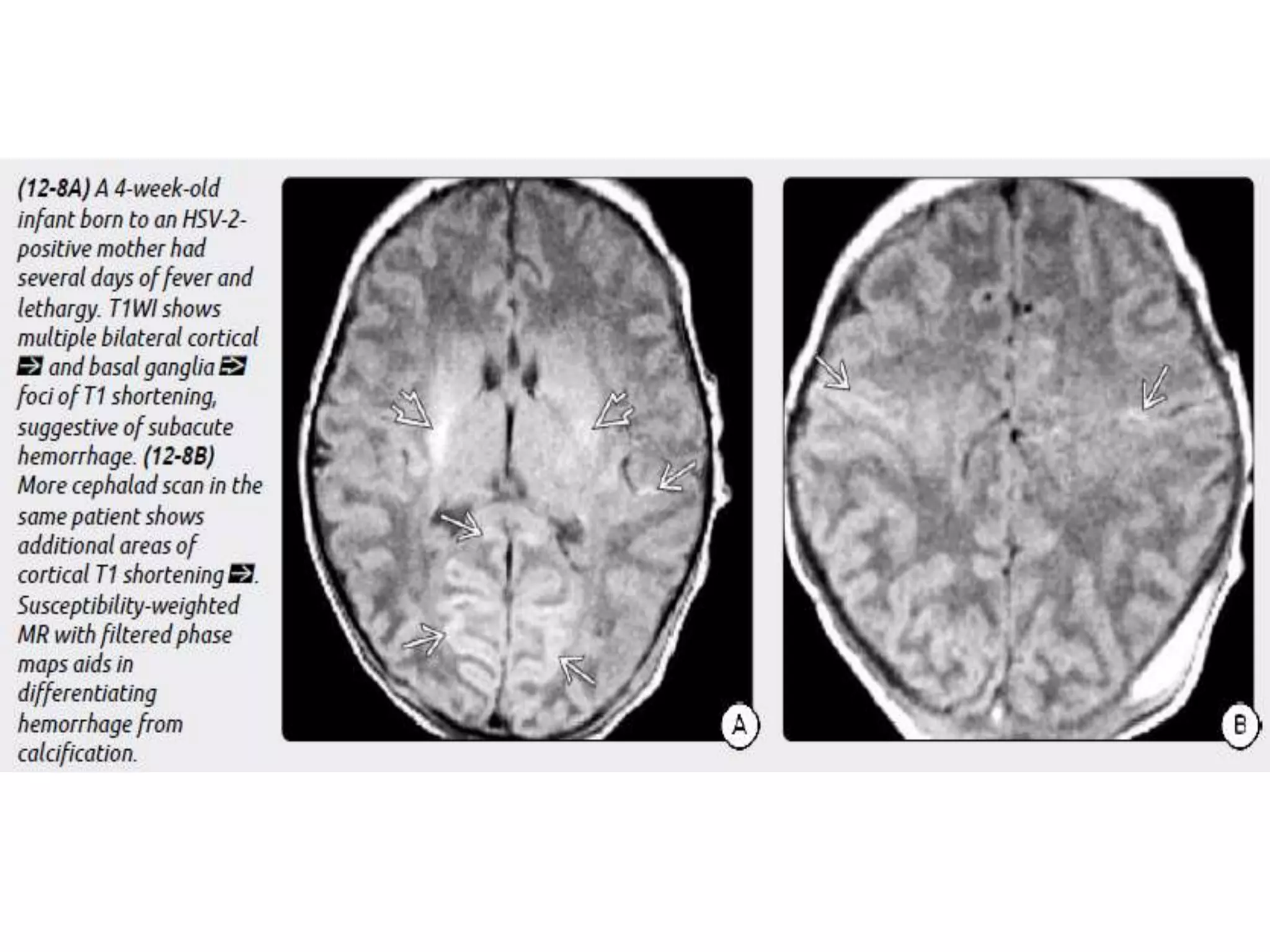 Imaging in CNS Infections | PPTX