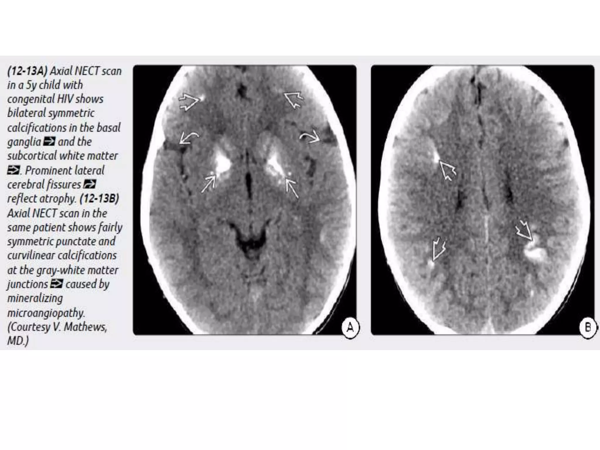 Imaging in CNS Infections | PPTX