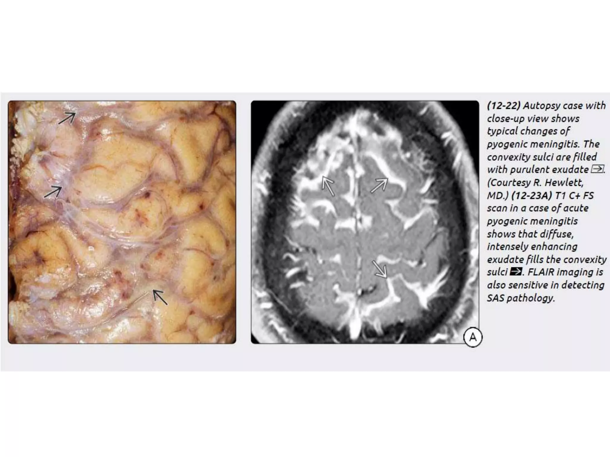 Imaging in CNS Infections | PPTX