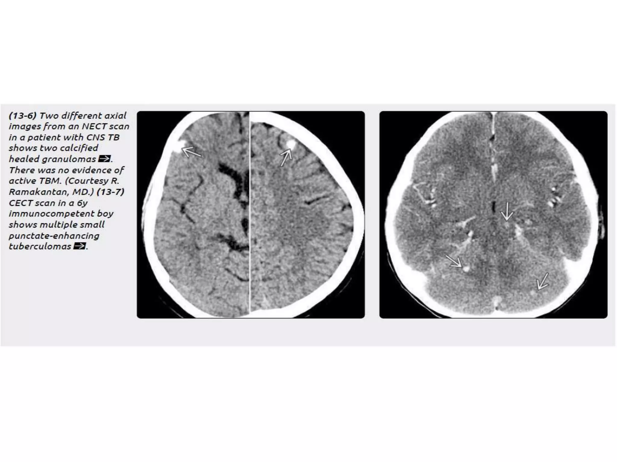Imaging in CNS Infections | PPTX